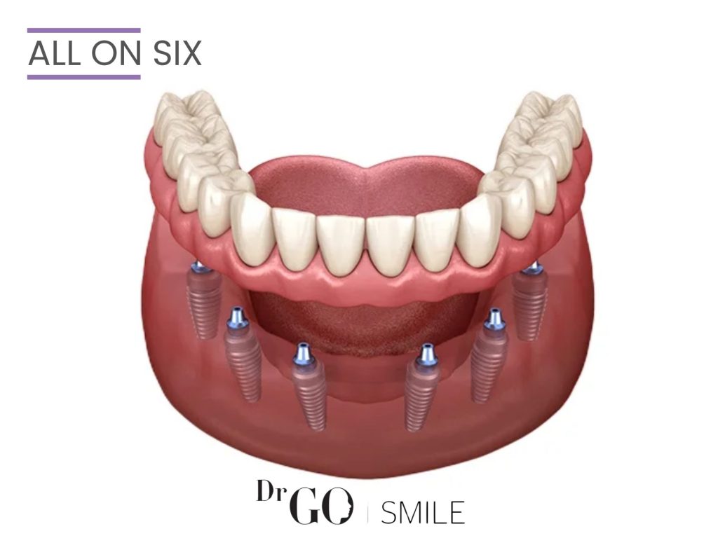 All-on-4 and All-on-6 Implant Systems: Comprehensive Oral ...