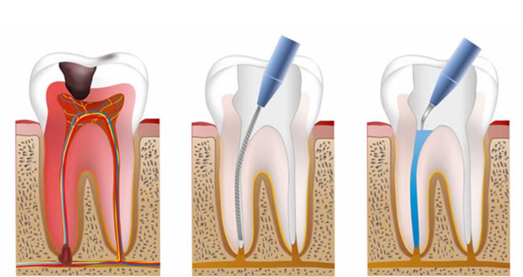 Root Canal Treatment Istanbul: A Comprehensive Guide to Pain-Free Dental Care - DRGO Smile Clinic