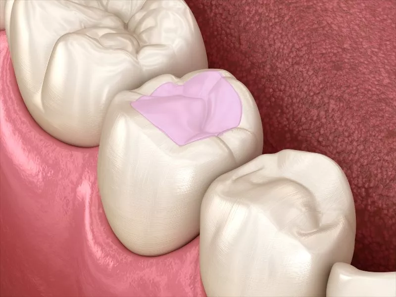 Composite Fillings Turkey Cost 2026 - DRGO Smile Clinic